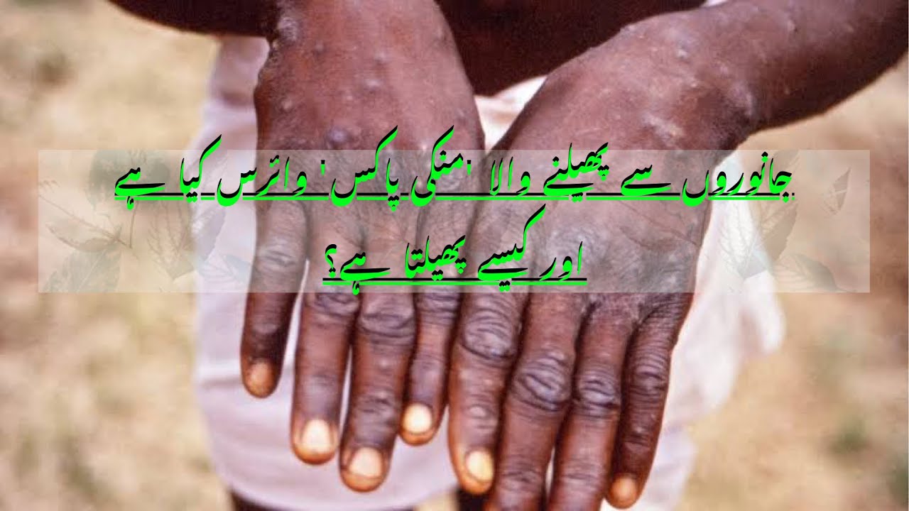 What is monkey pox 🦠 |what is they symptoms| prevention #monkeypoxcase ...