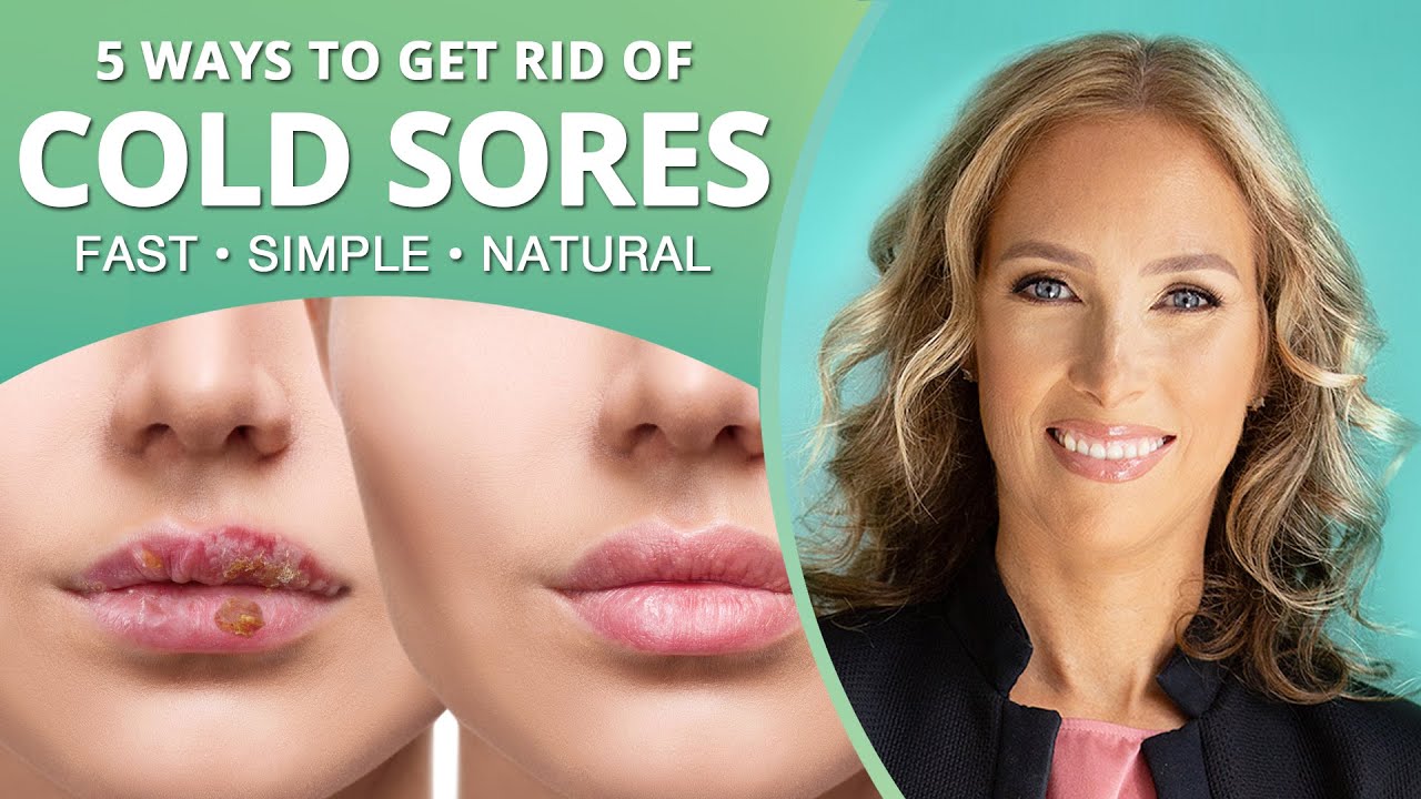 Cold Sores | 5 Ways to Get Rid of Cold Sores Overnight | Dr. J9 Live ...