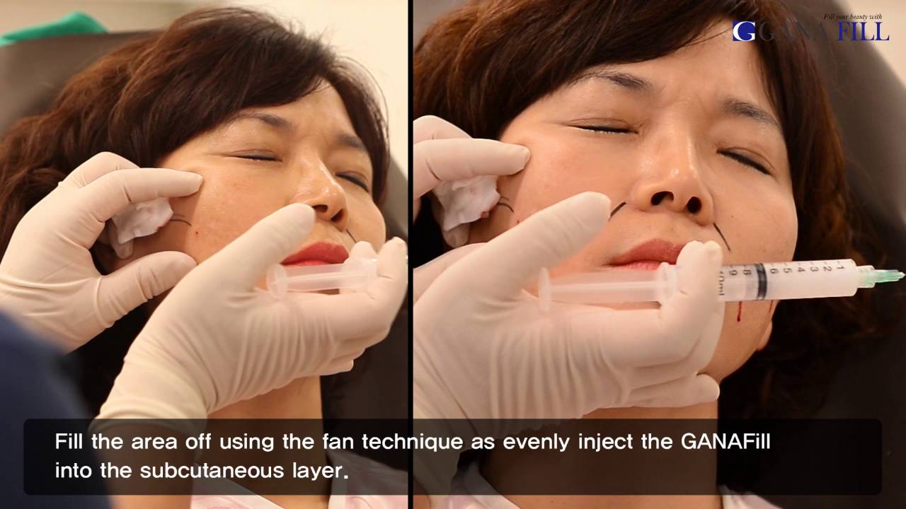 Gana Fill Носогубные складки и скулы. - YouTube
