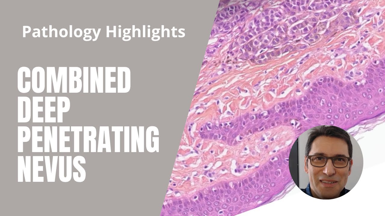 Pathology Highlights : Combined deep penetrating nevus - YouTube