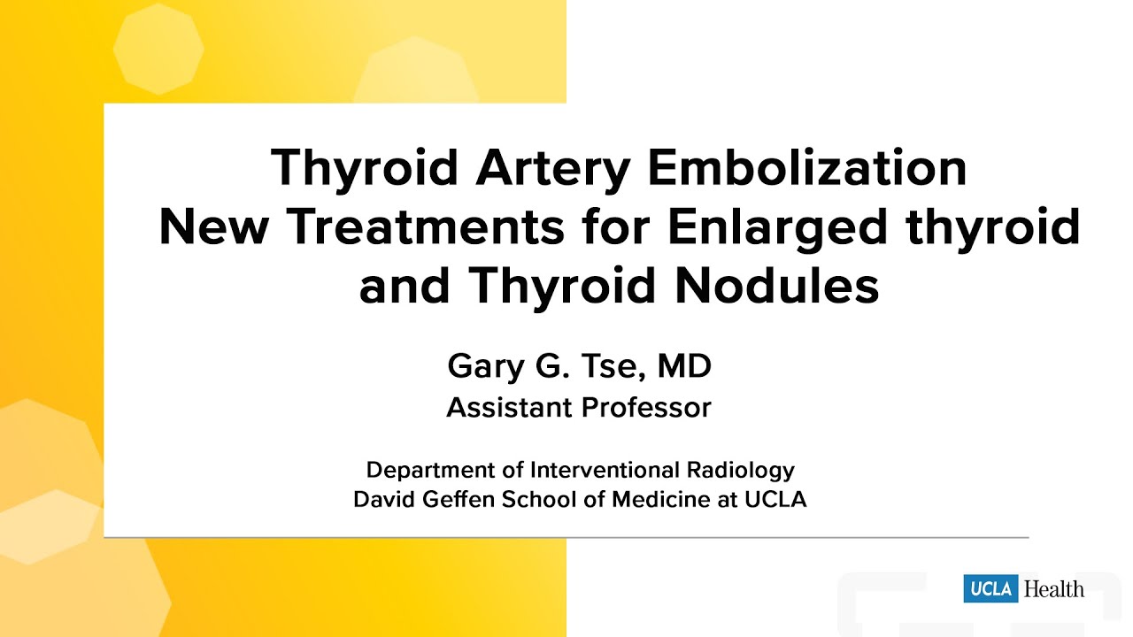 Thyroid Artery Embolization: New treatments for enlarged thyroid and ...