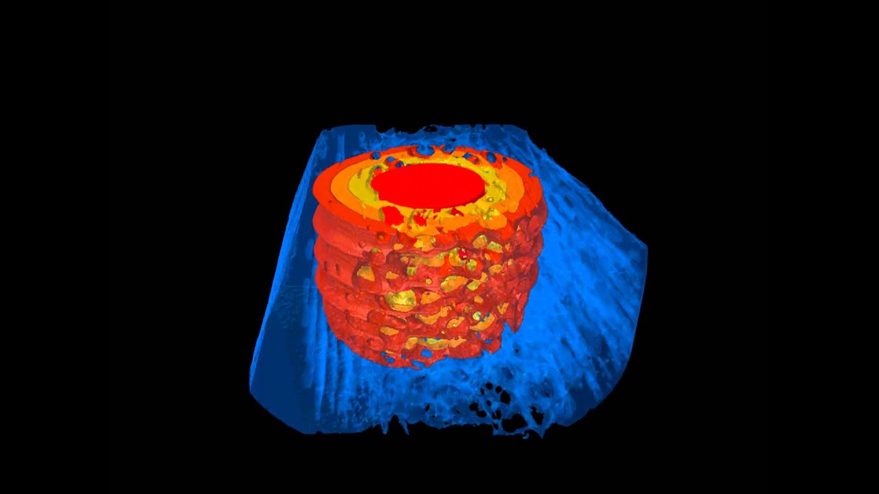 Orthopedic titanium implant in bone, osteointegration. Micro-CT scan ...