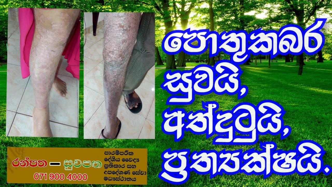 Psoriasis පොතු කබර Ayurveda Treatment Sinhalese | Potu Kabara සුවයි ...