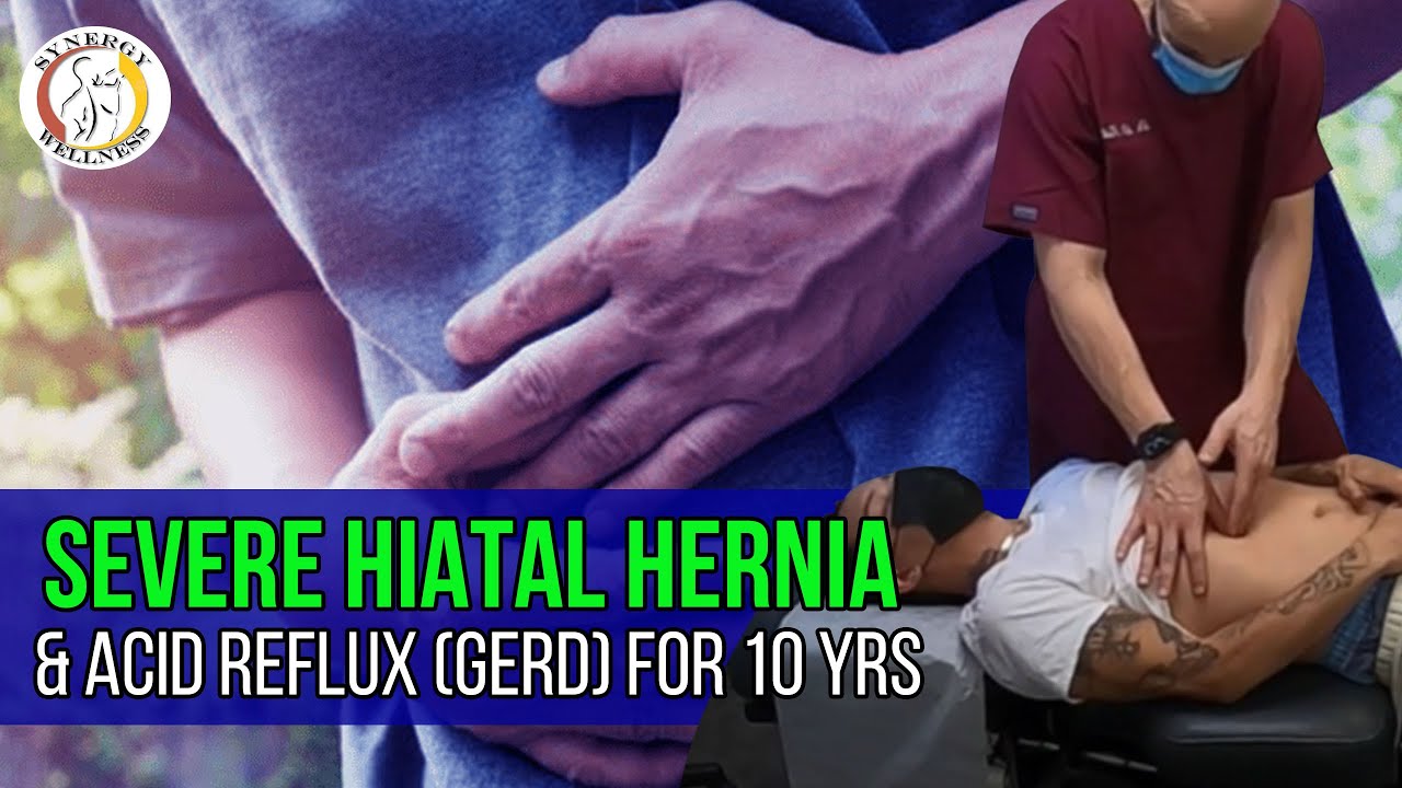 SEVERE HIATAL HERNIA & ACID REFLUX (GERD) for 10 Yrs - NON Surgical ...