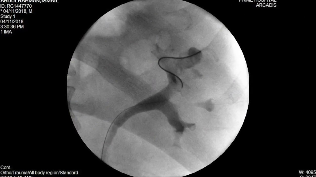 INTRA RENAL SURGERY CALYCEAL STONE GRADE 3 DIVERTICULUM YouTube INTRA RENAL SURGERY CALYCEAL STONE GRADE 3 DIVERTICULUM YouTube