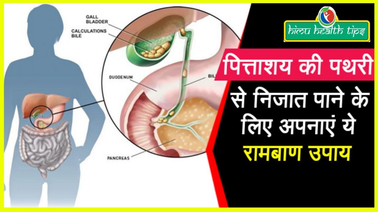 पित्ताशय की पथरी का घरेलू उपचार | pit ki pathri ka ilaj | Gallbladder ...