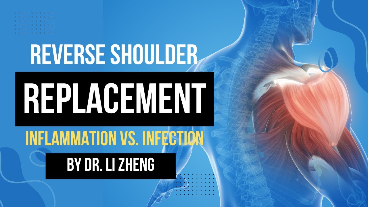 Reverse Shoulder Replacement: Inflammation vs. Infection - YouTube