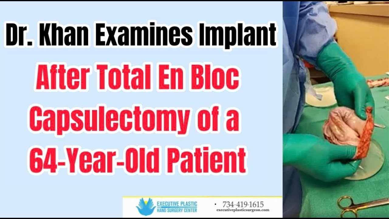 Dr Khan Examines Implant After Total En Bloc Capsulectomy Of A 64 Year