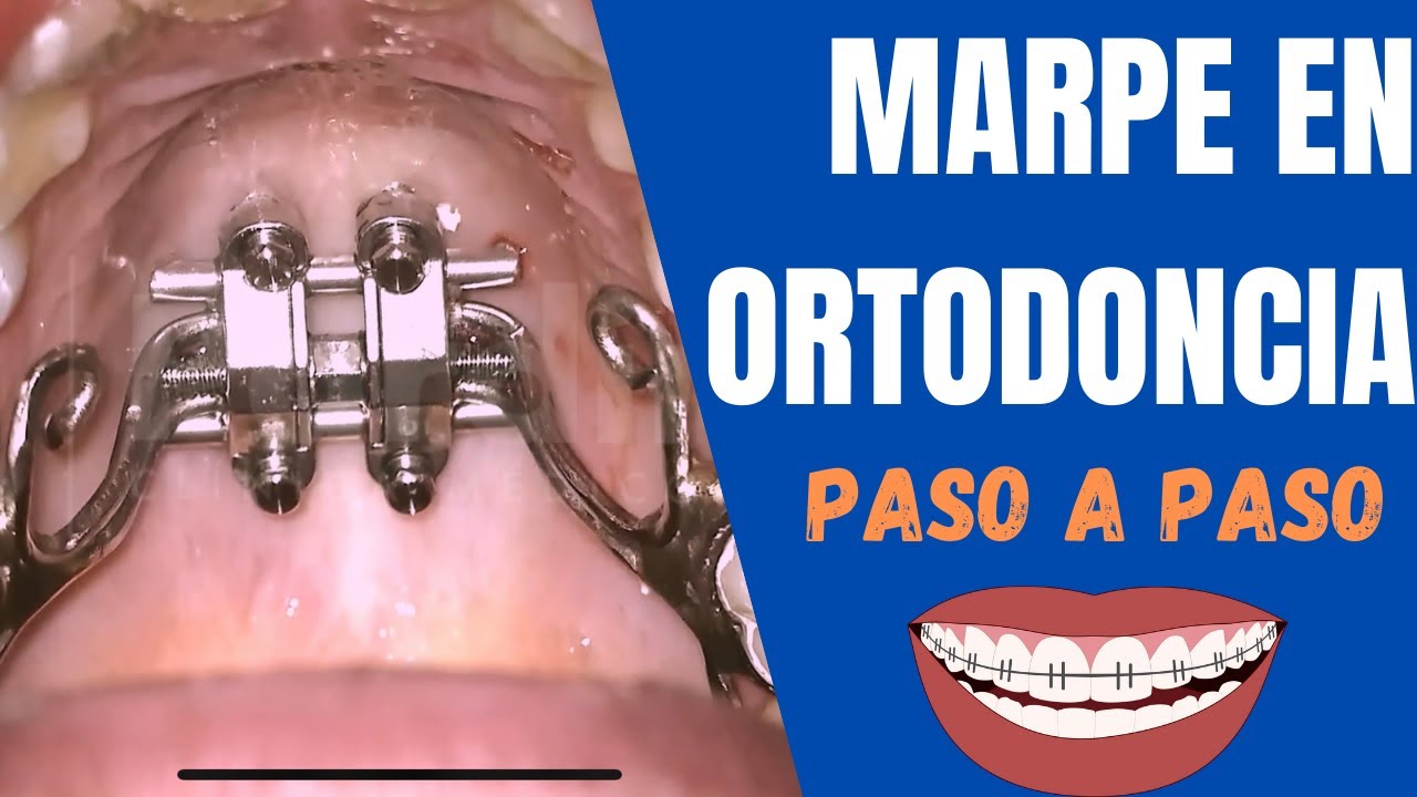 Colocación de un DISYUNTOR de ORTODONCIA en el paladar - MARPE en ...