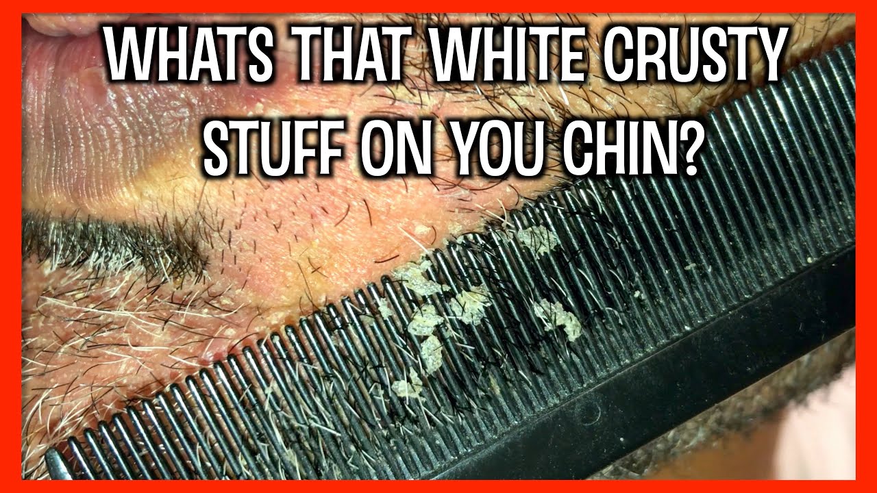 BEARD and EYEBROW FLAKES | DANDRUFF FLAKES | SEBORRHEIC DERMATITIS ...