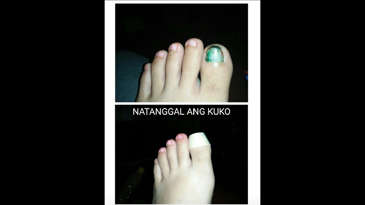 Natanggal ang kuko 😱😱😱 - YouTube
