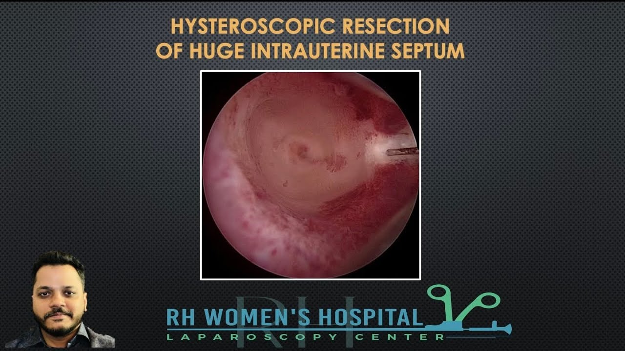 #126 : HYSTEROSCOPIC RESECTION OF HUGE INTRAUTERINE SEPTUM - YouTube