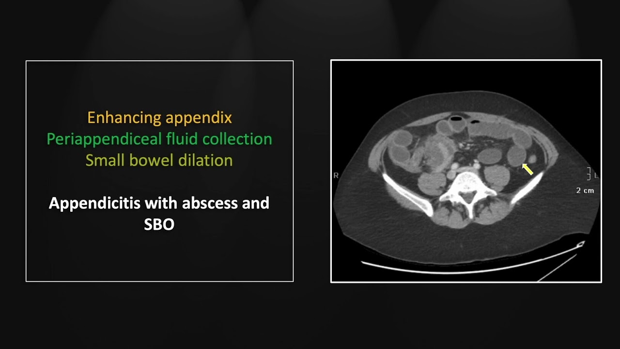 Appendicitis | Interesting Radiology Cases - YouTube