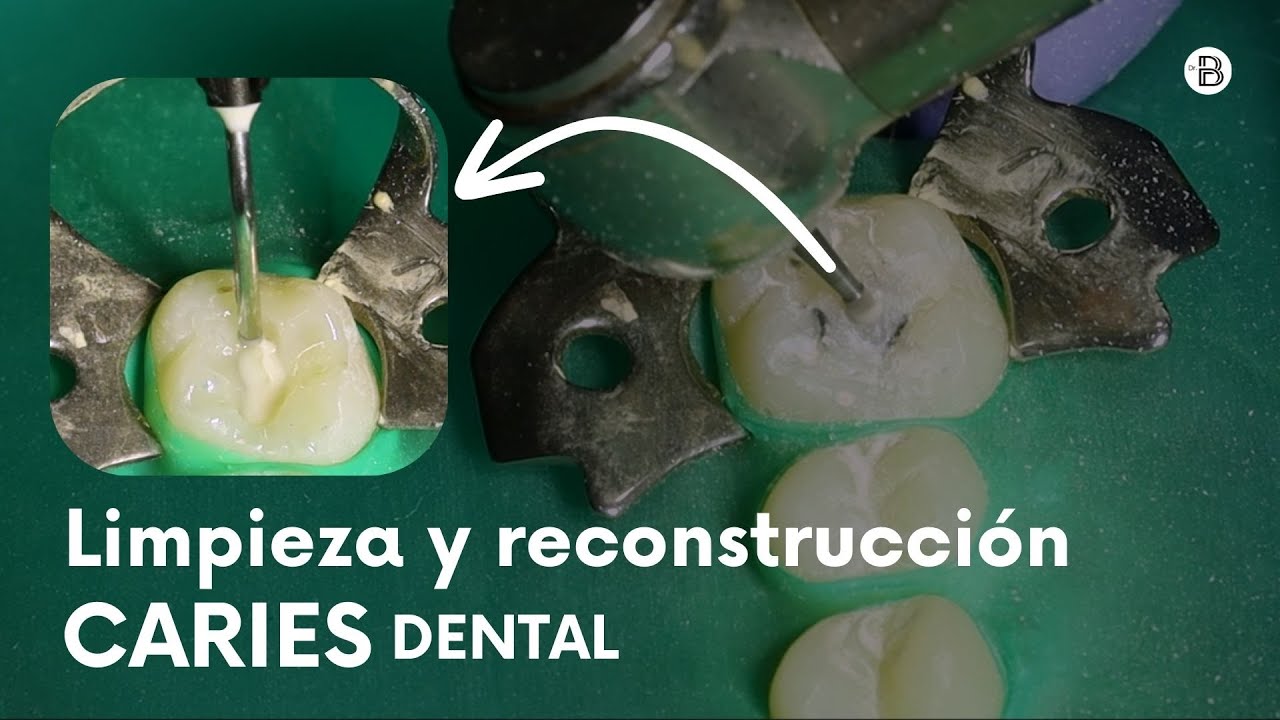 Limpieza y reconstrucción de CARIES dental PASO A PASO. - YouTube