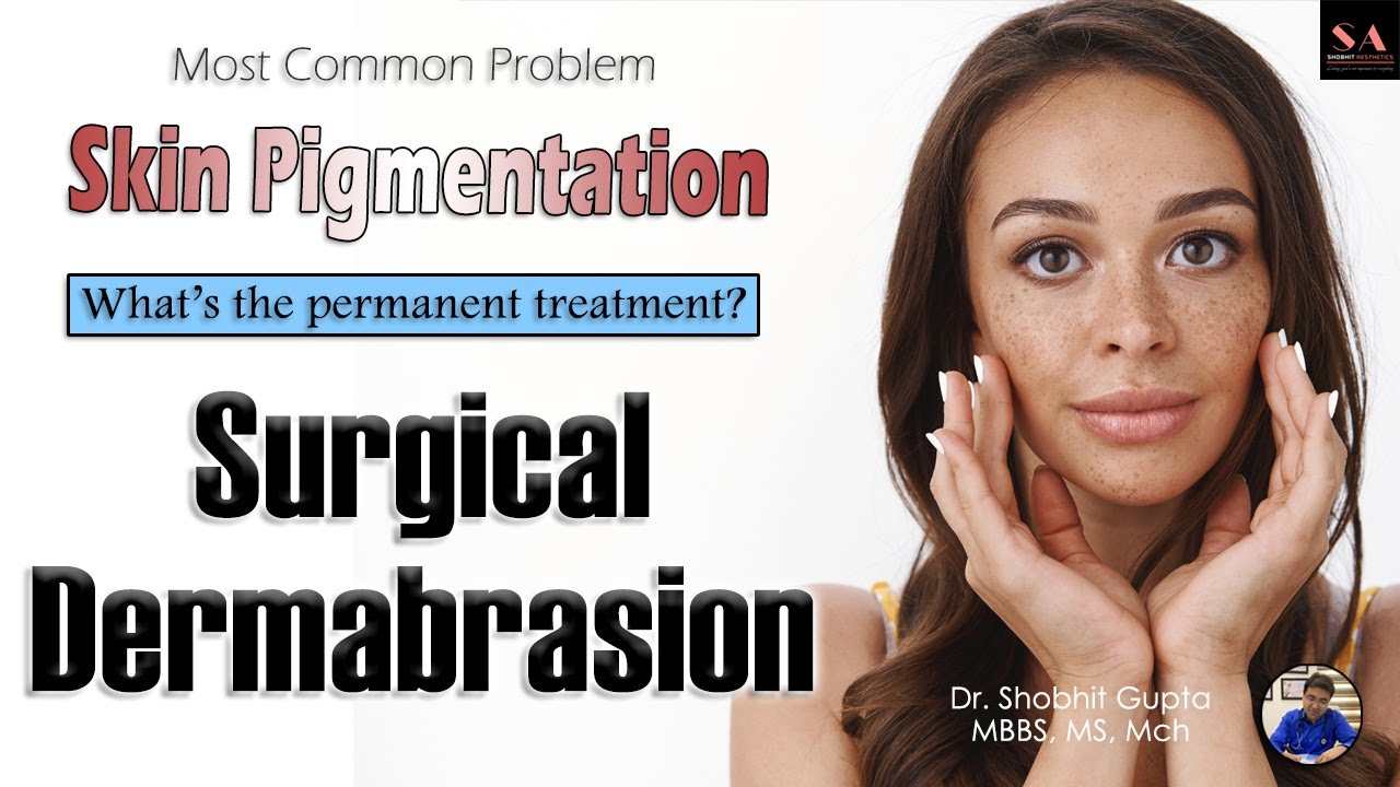 Surgical Dermabrasion | Best Treatment | Skin Pigmentation | Shobhit ...