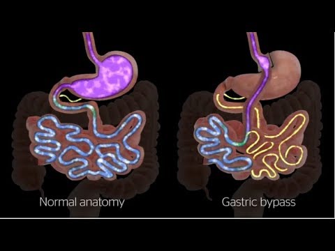 Gastric Bypass Procedure Animation - YouTube