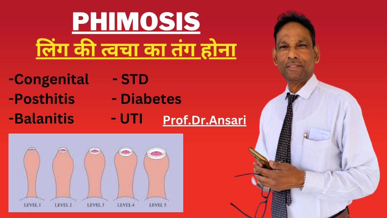 Phimosis | Tight foreskin of penis | Ling ki skin ka tight hona ...