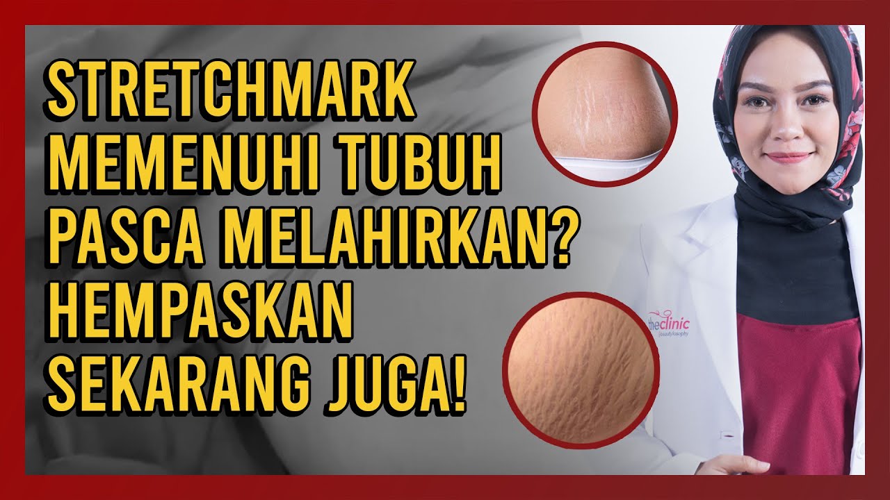 INILAH CARA MENGHILANGKAN STRETCH MARK DENGAN CEPAT PASCA MELAHIRKAN ...