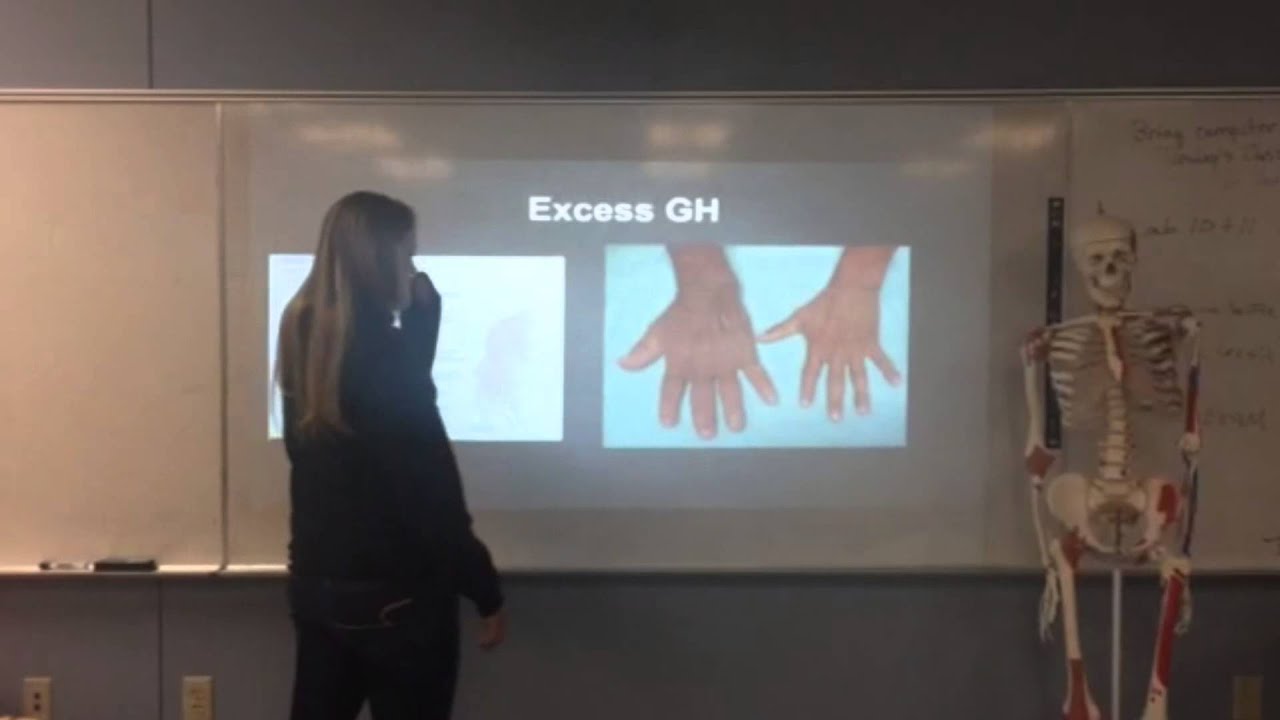 Acromegaly - Anatomy and Physiology II Final Video - YouTube