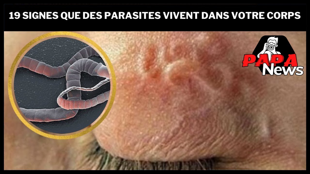 19 signes que des parasites vivent dans votre corps - YouTube