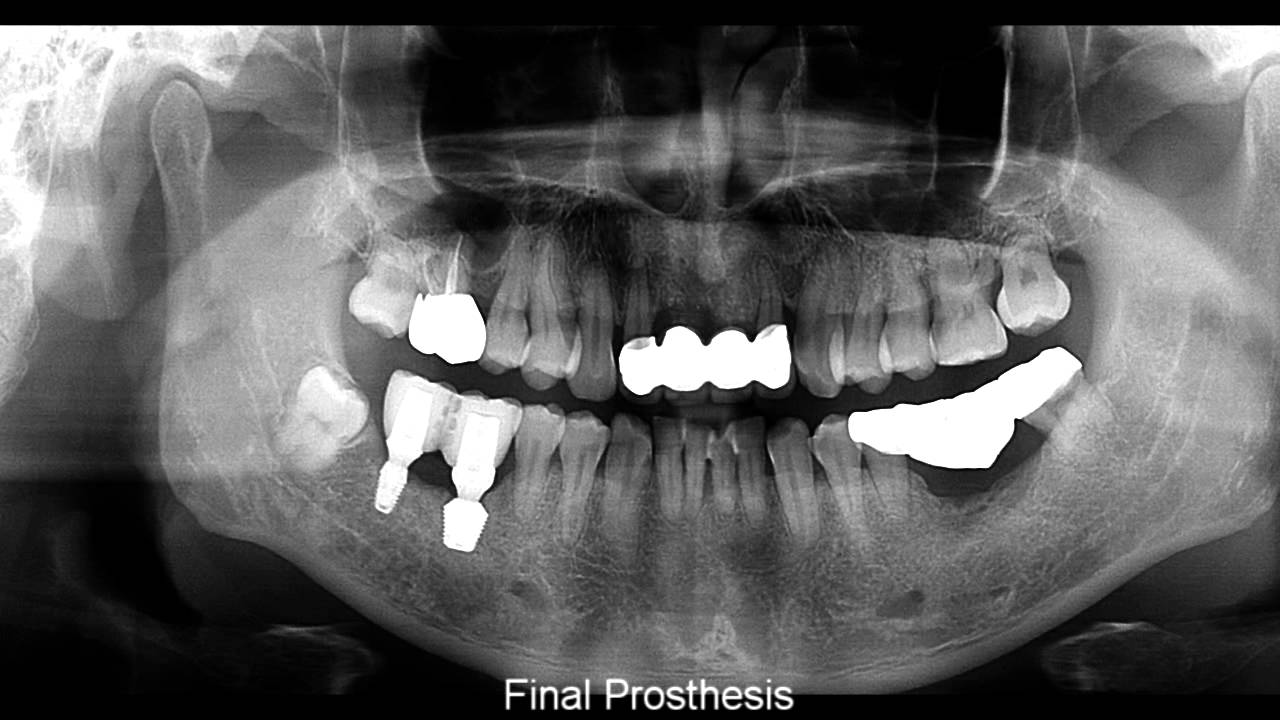 Short Implants Posterior Mandible