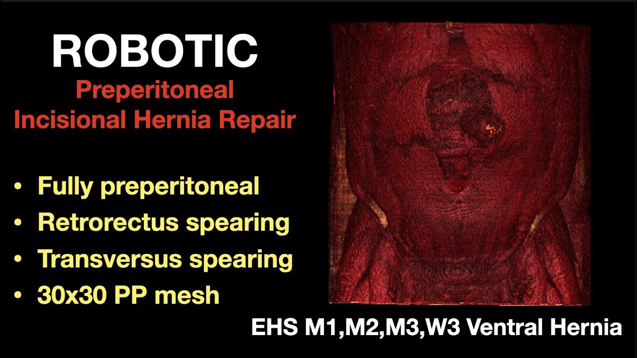 Robotic preperitoneal incisional hernia repair M1,2,3 W3. Spearing ...