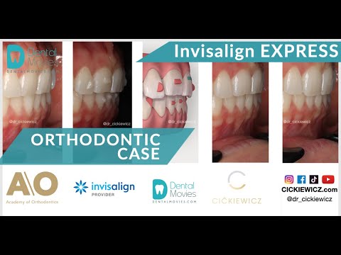 Orthodontic case -  INVISALIGN Express - TRAUMATIC BITE / CROWDINGS / ROTATIONS