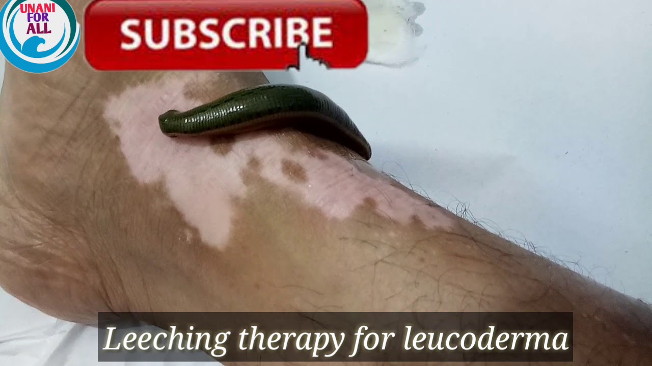 Leeching therapy for leucoderma - YouTube