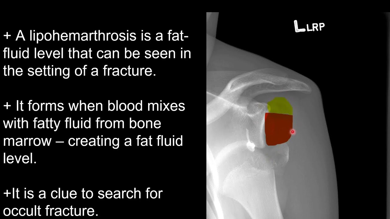 Shoulder X-Ray: Anterior Dislocation and its Complications - YouTube