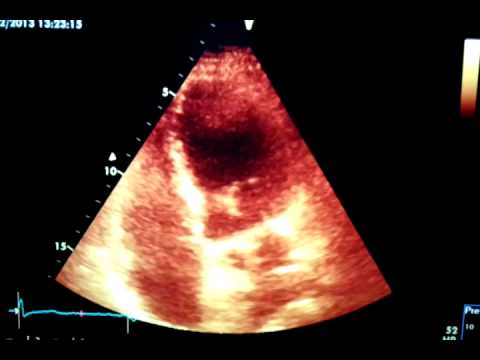 PERICARDIAL CONSTRICTION 4CV : APICAL VENTR SEPTUM ABNORMAL MOTION ...
