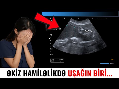 Əkiz hamiləlikdə uşağın biri inkişafdan qaldıqda nə etmək lazımdır?
