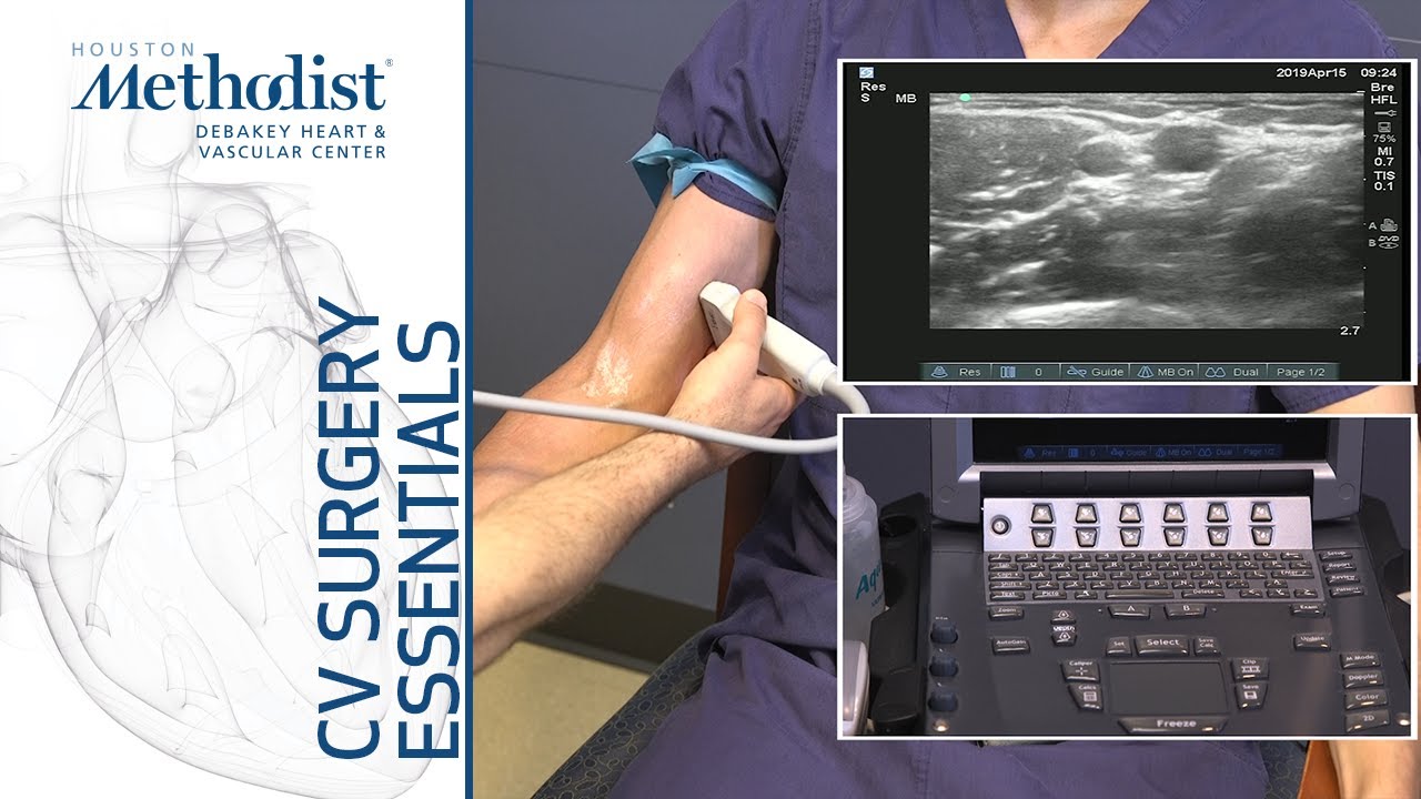 Vessel Mapping for Percutaneous Fistula (Eric Peden, MD) - YouTube