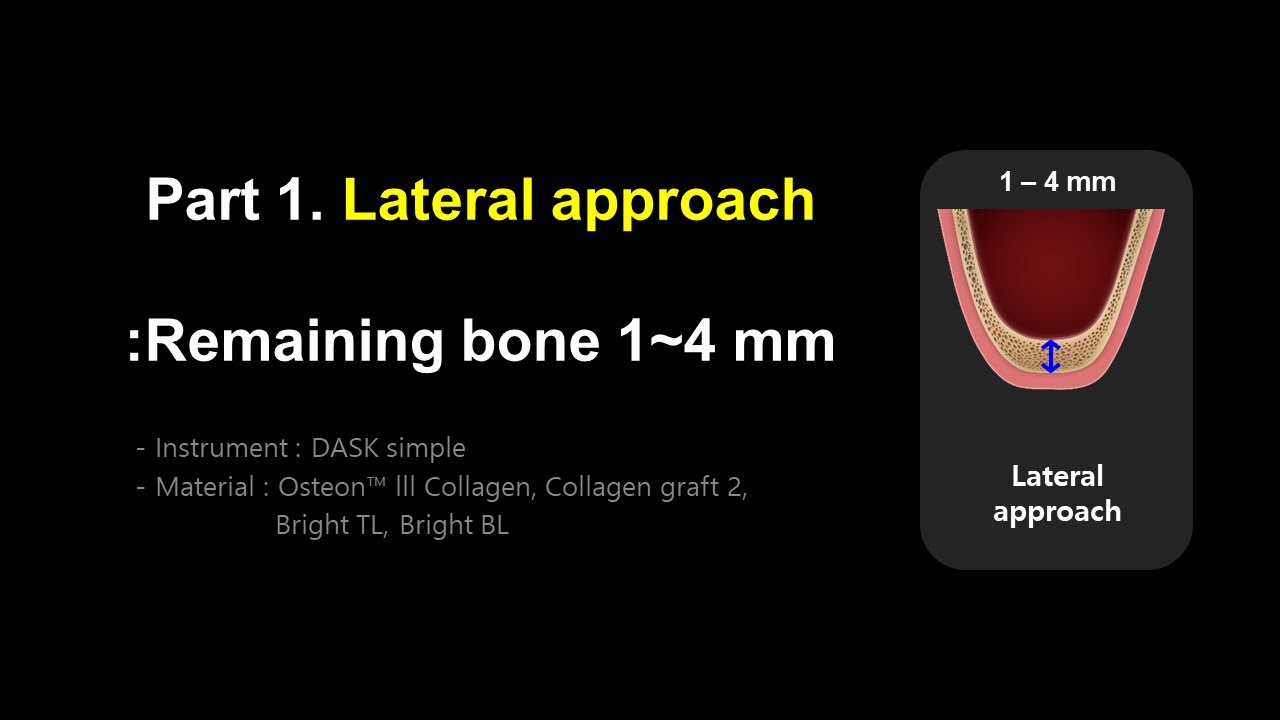 Sinus treatment_Part 1. Lateral approach - YouTube