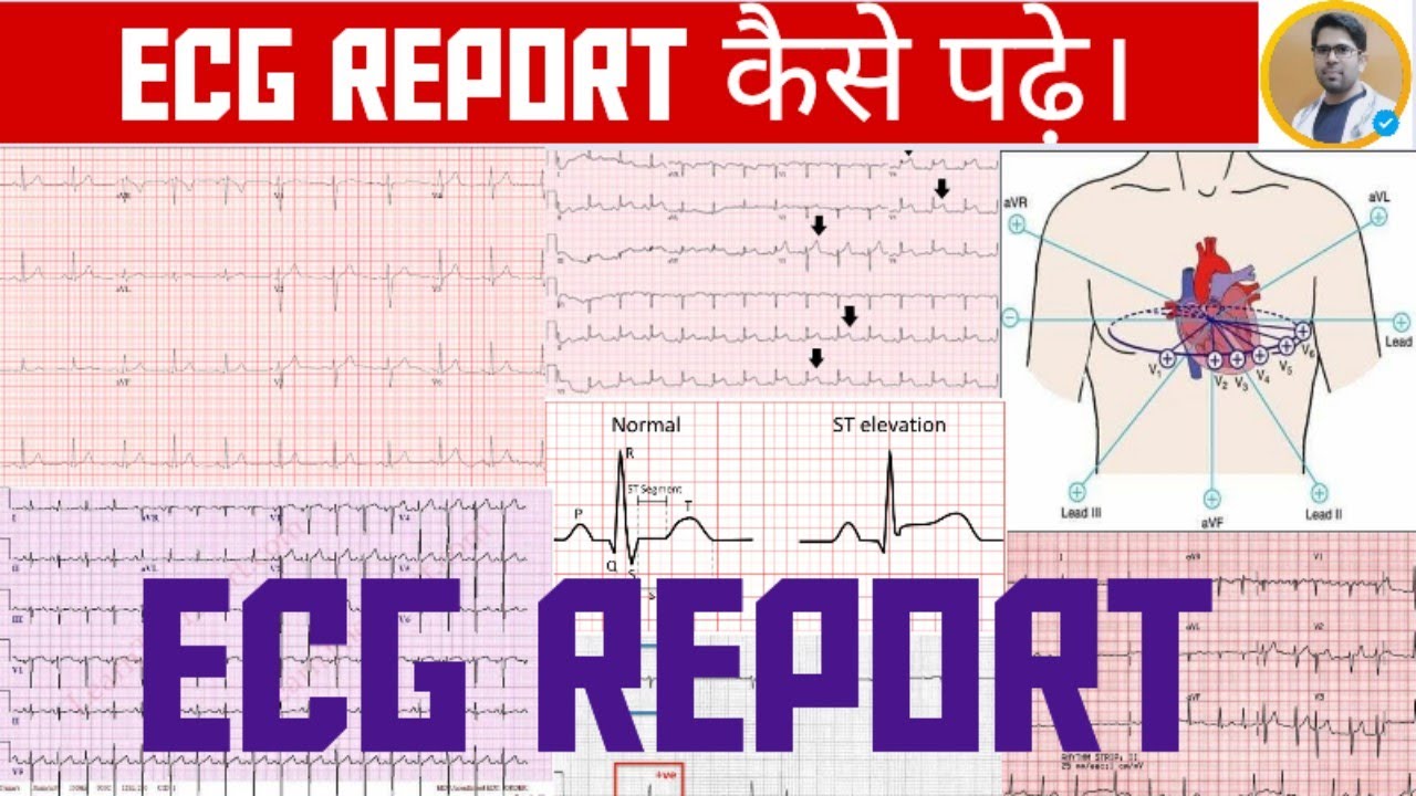 ECG REPORT HOW TO READ AN ECG REPORT ECG REPORTS 