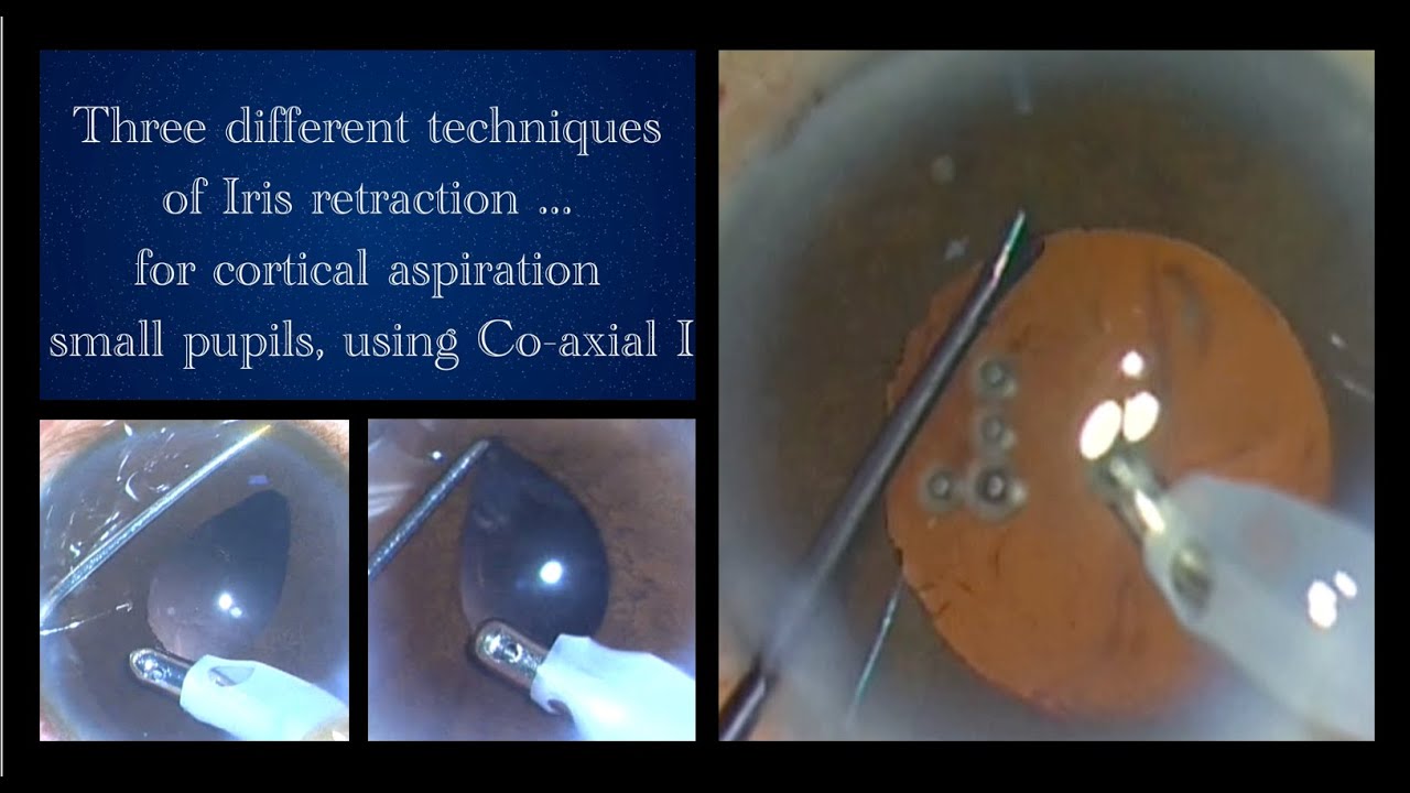 Three different ways to retract the iris for cortex removal in small ...