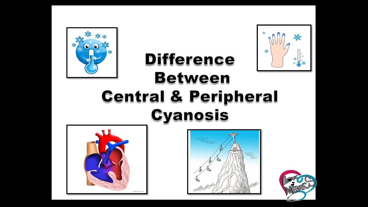 Central Cyanosis Vs Peripheral Cyanosis