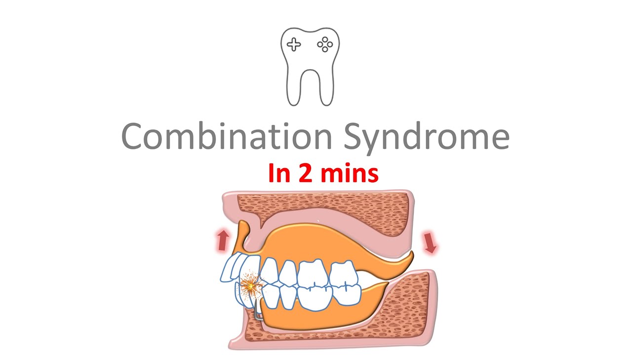 Combination Syndrome in 2 mins - YouTube