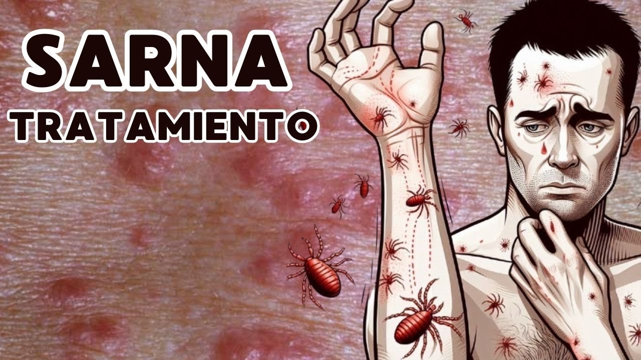 Sarna Humana Tratamiento Escabiosis Sarcoptes scabiei - YouTube