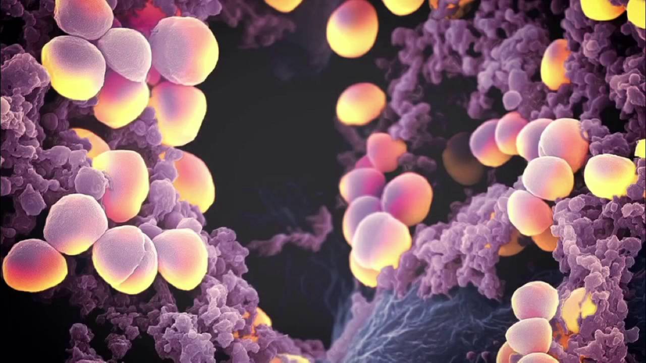 ABSCESO MAMARIO CAUSAS SÍNTOMAS Y TRATAMIENTO - YouTube