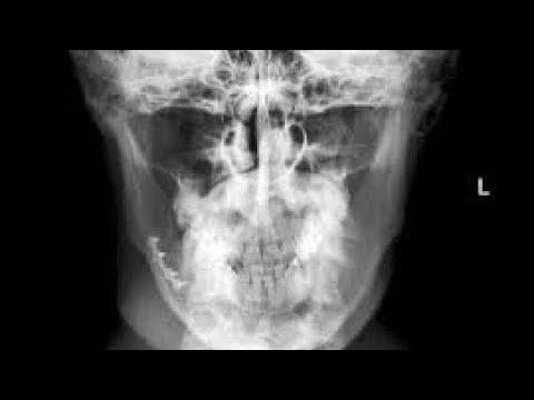 Çene: Argüman nedir?
