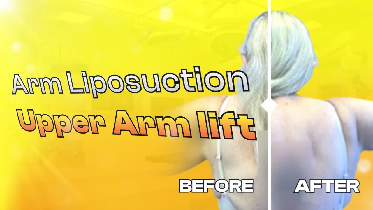 Transform Your Upper Arm With This Revolutionary Surgery - YouTube