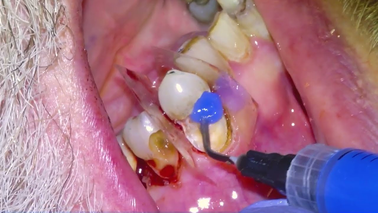 [27] Deep gumline decay restored with dental fillings - YouTube