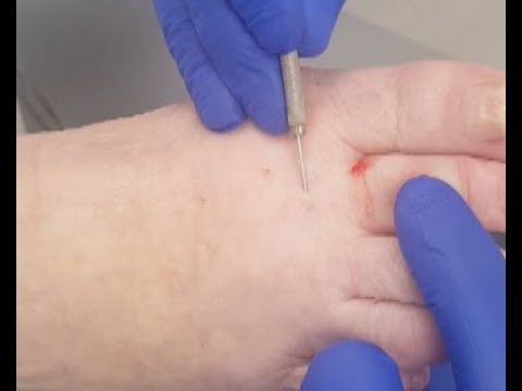 Tenotomies can work well for flexible hammertoes - YouTube