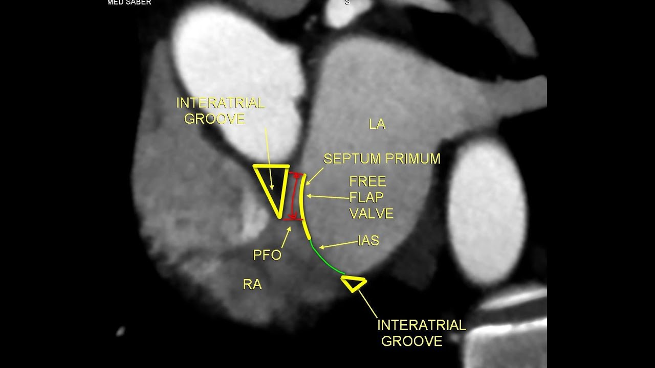 PFO incidental finding in low dose coronary CTA 70 Kvp (DLP =172) - YouTube