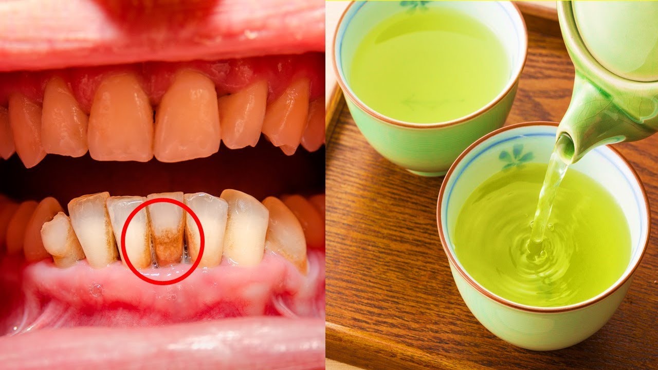 5 Ways Green Tea is Good For Your Teeth And Gums - YouTube