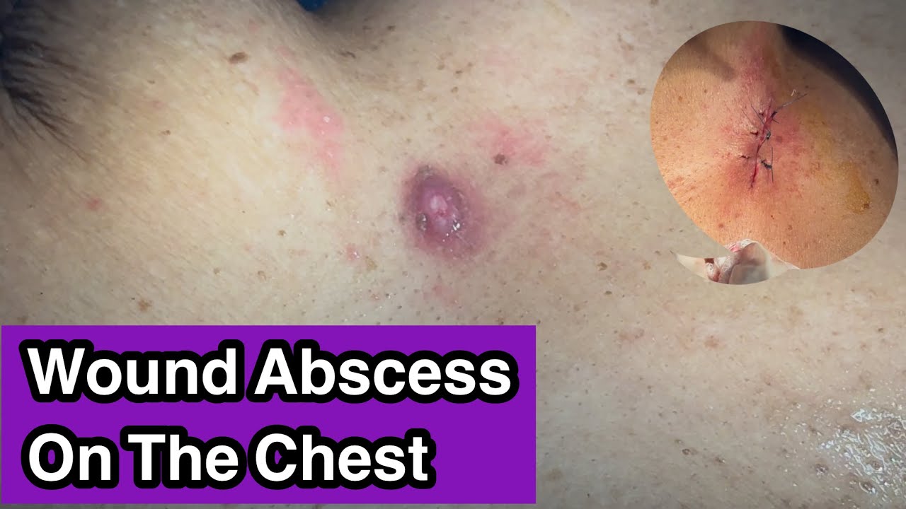 Wound Abscess On Chest Removal - YouTube