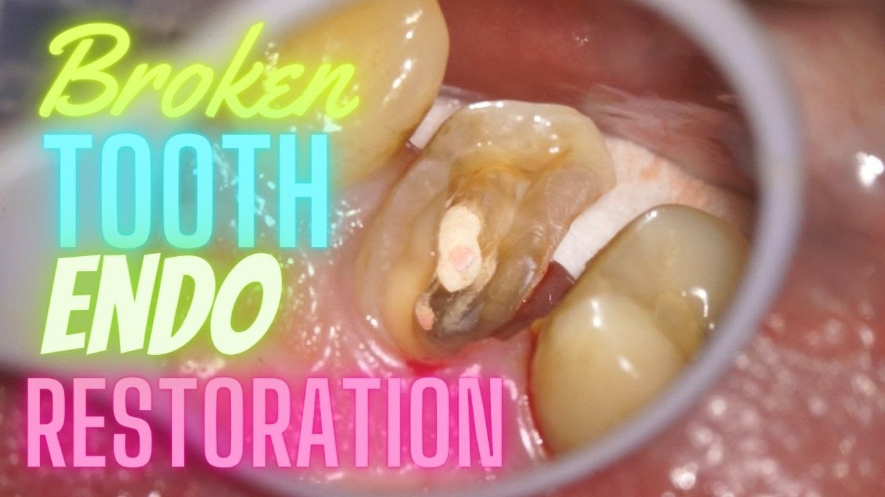Broken tooth endodontic retreatment, gingivectomy, build-up - YouTube