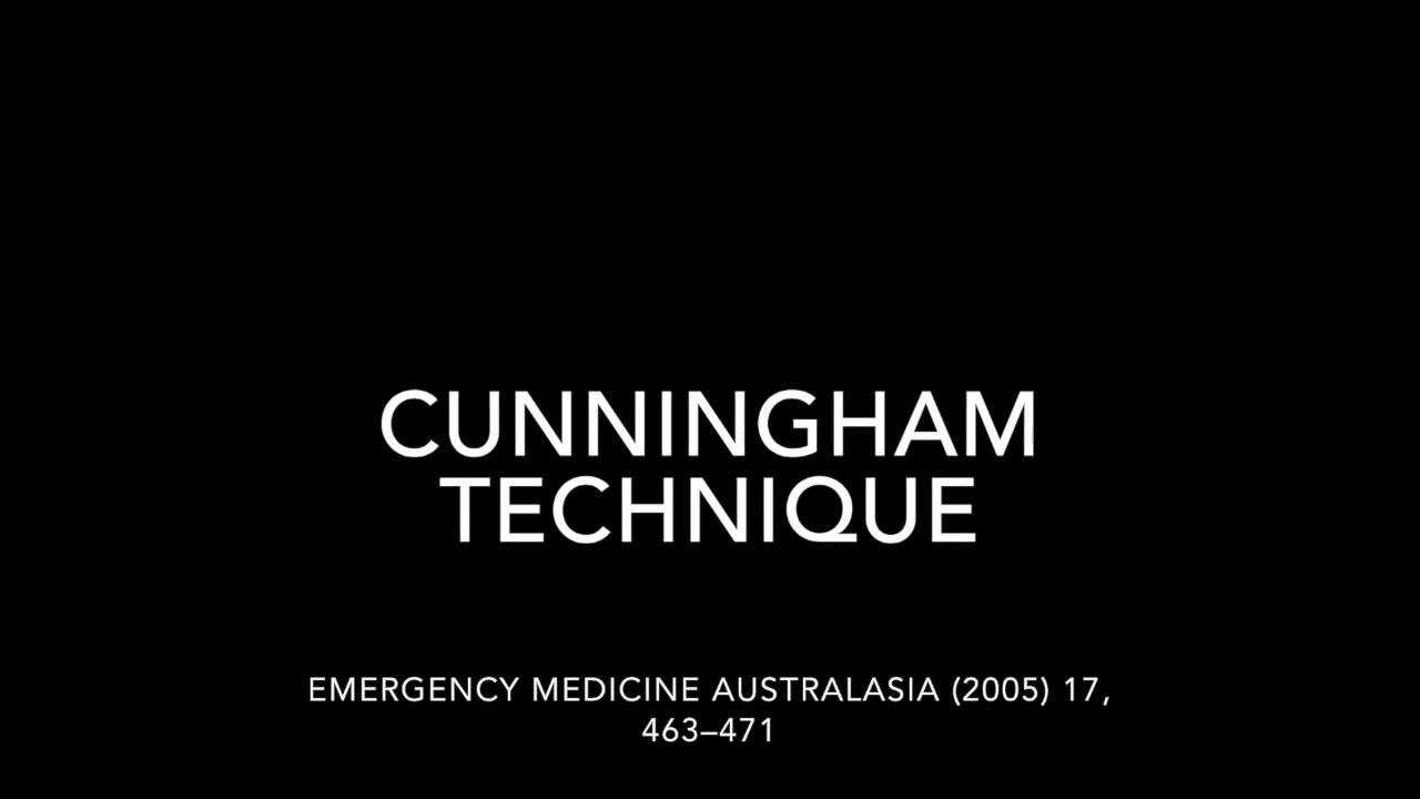 Shoulder Dislocation: Cunningham Technique - YouTube