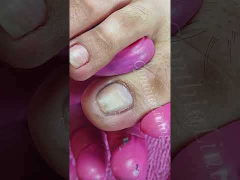 Full video pedicure with ingrown removal 