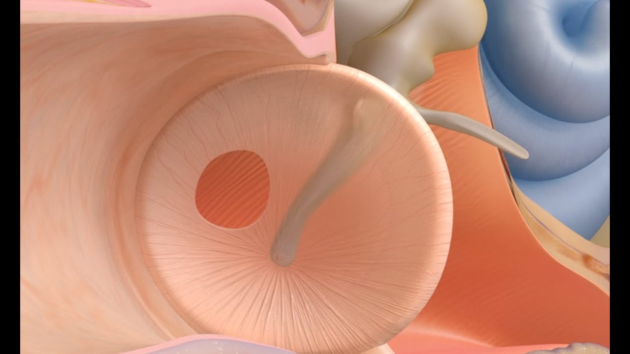 Tympanoplasty - YouTube